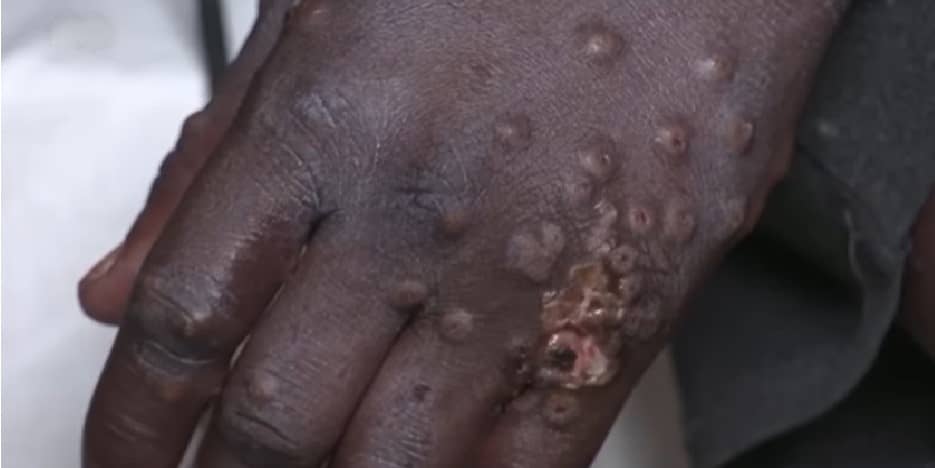 Marokko meldt eerste geval van mpox, variant nog onbekend - KEY NEWS ...